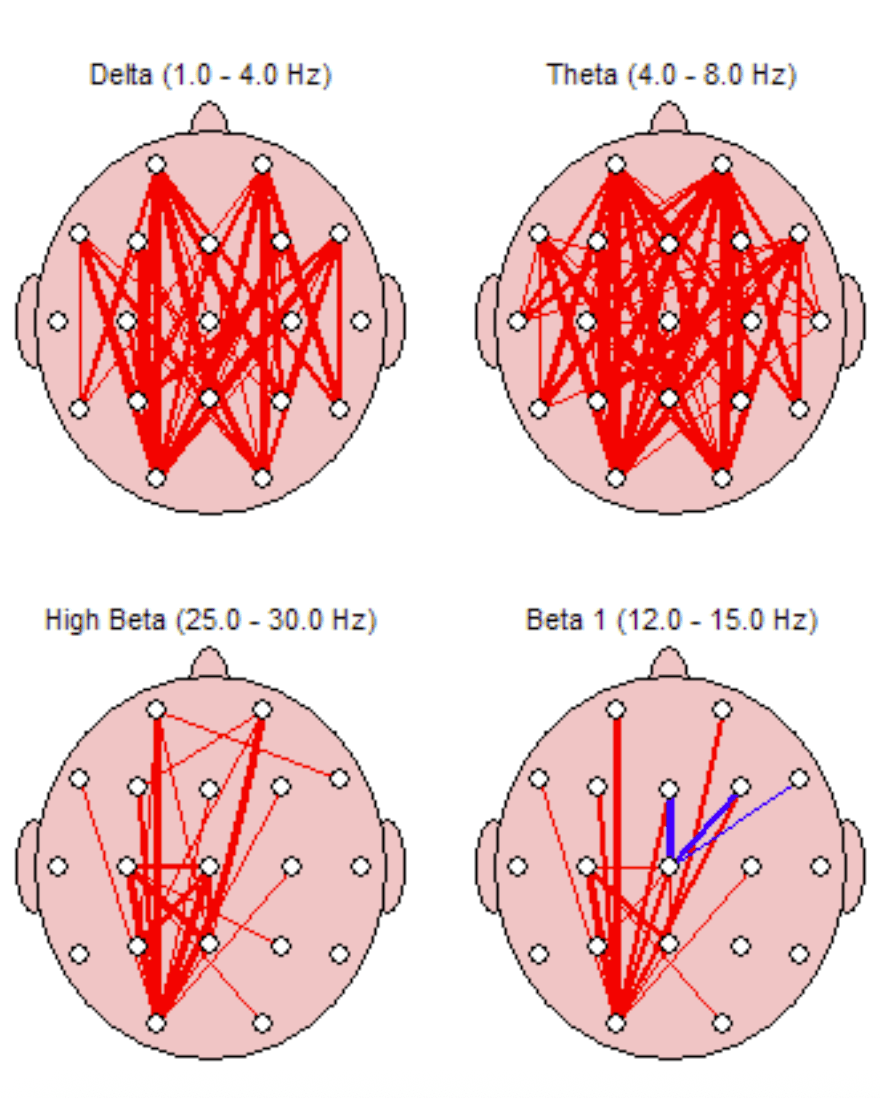 qEEG Brain Mapping: Discover What Other Tests Miss